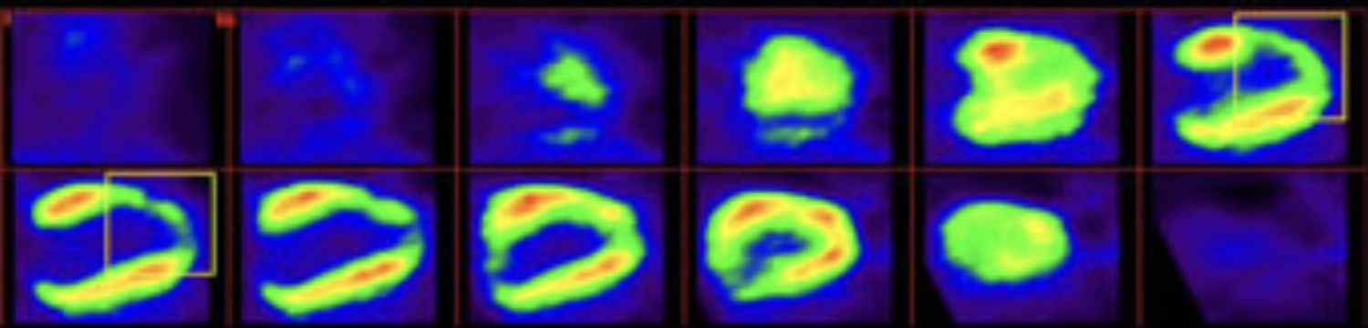 CellProthera | Post-AMI